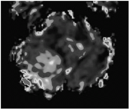 Intra-Axial Tumors | Radiology Key