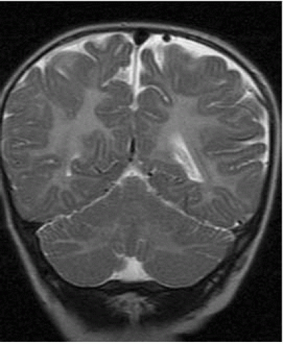 Leukodystrophies | Radiology Key