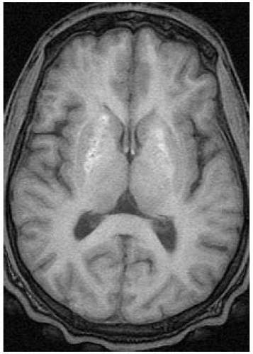 Leukodystrophies | Radiology Key