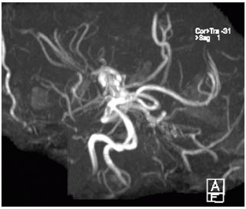 Neurocutaneous Syndromes | Radiology Key