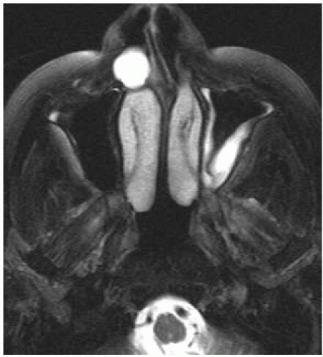 Neck Masses | Radiology Key