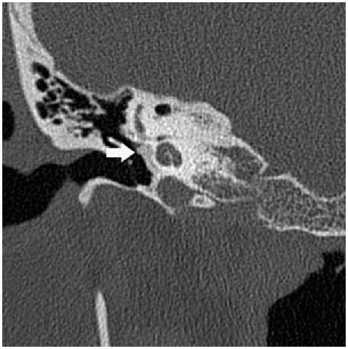 Temporal Bone | Radiology Key