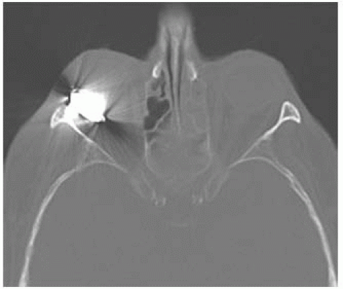 Orbits: Orbital Pathology | Radiology Key