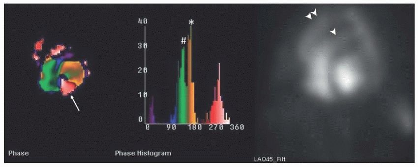 Nuclear Cardiology | Radiology Key