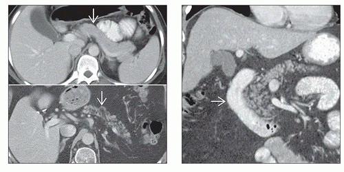 Imaging Approach to the Pancreas | Radiology Key