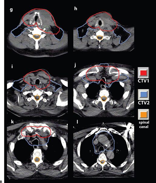 Thyroid Carcinoma | Radiology Key