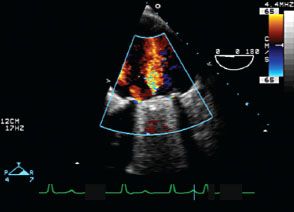 Prosthetic Valves | Radiology Key