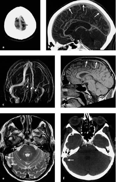Cerebral Venous and Sinus Thrombosis | Radiology Key