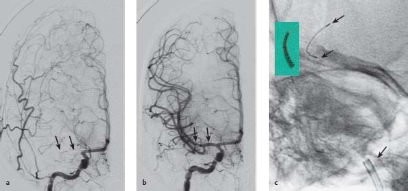 Mechanical Recanalization Materials | Radiology Key