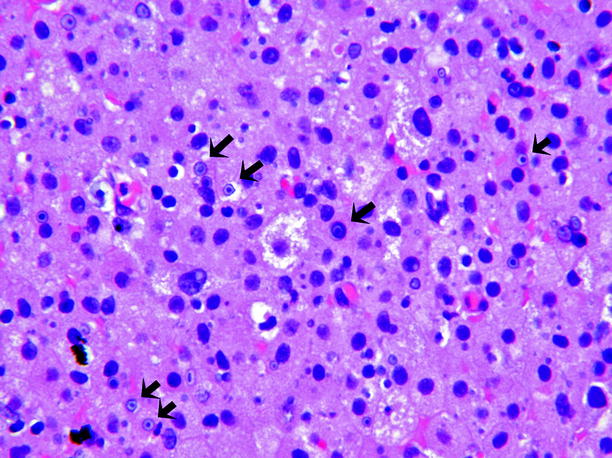 Nonneoplastic Disorders of the Bladder | Radiology Key