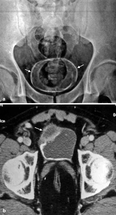 Neoplasms of the Bladder | Radiology Key