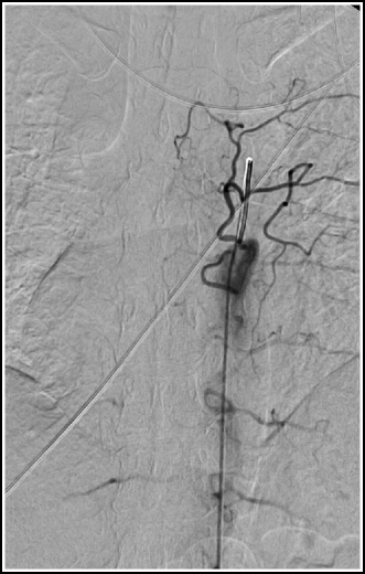 Spinal Angiography | Radiology Key