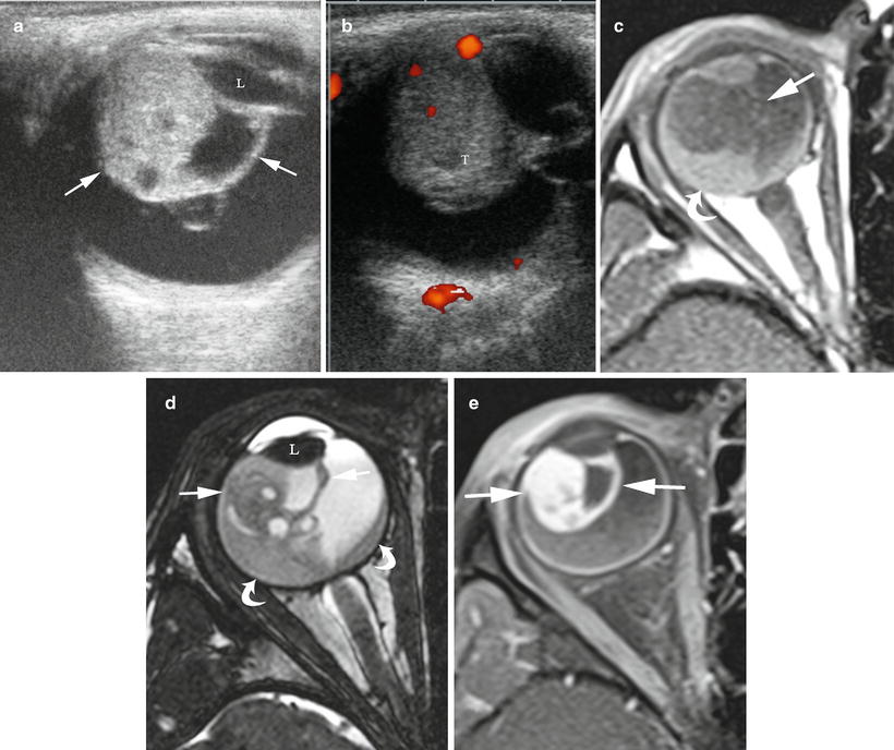 Intraocular Tumors | Radiology Key