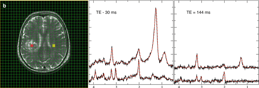 Spectroscopic Imaging | Radiology Key