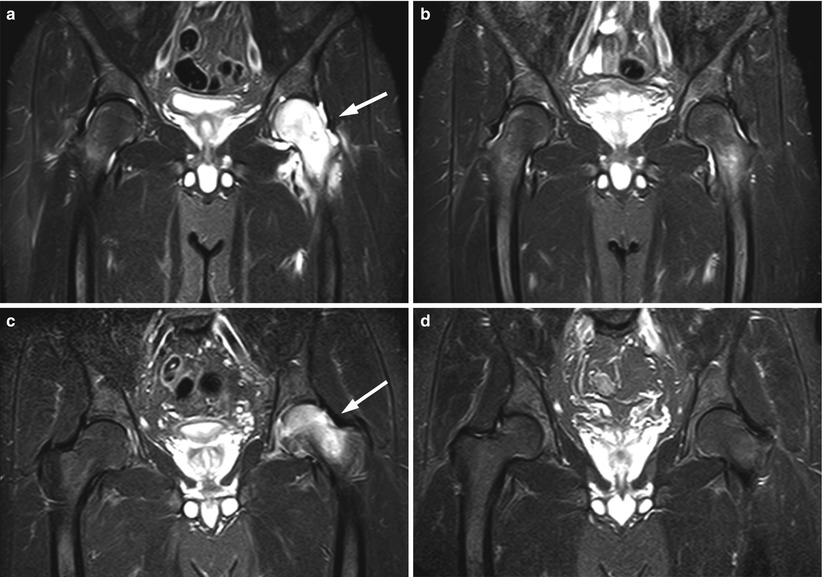 Bone Marrow Edema Pattern Radiology Key