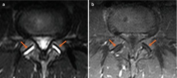 Facet Joint Effusion | Radiology Key