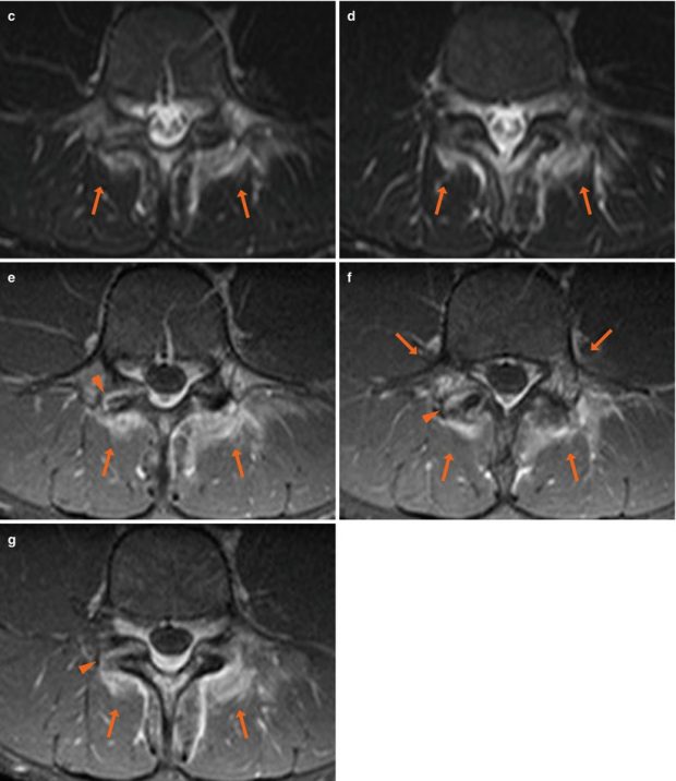 Radiculitis | Radiology Key