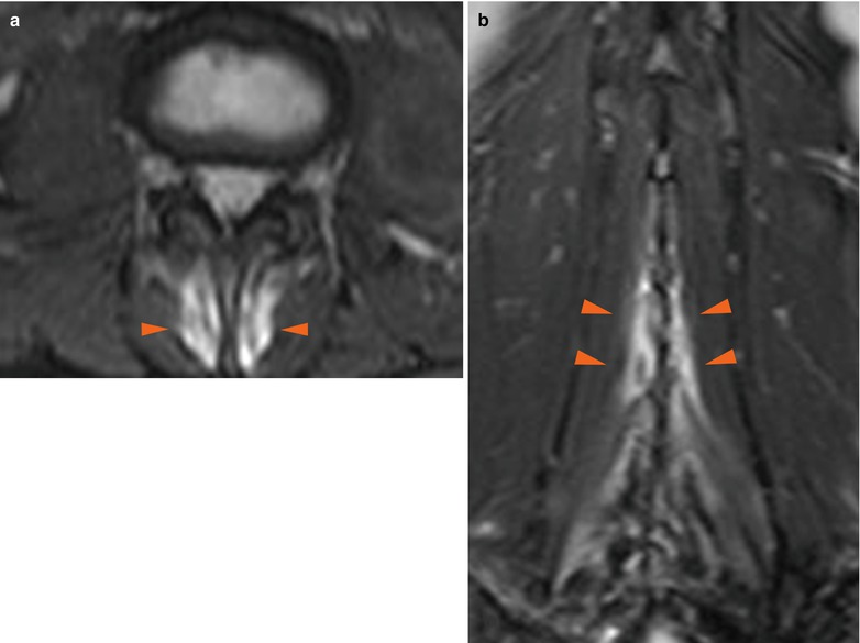 Muscular Inflammation | Radiology Key