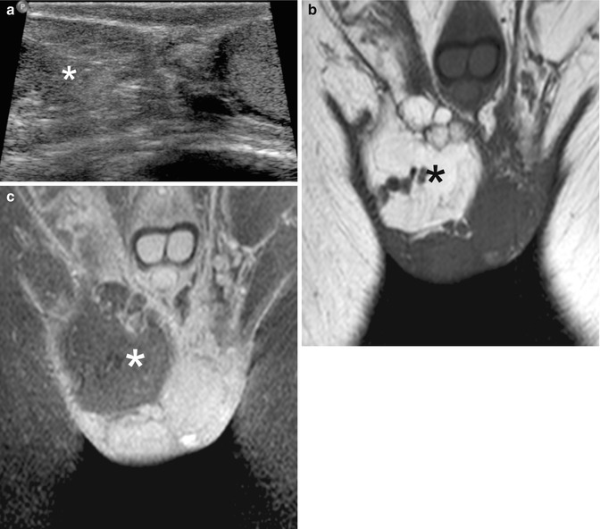 MR Imaging of the Scrotum | Radiology Key