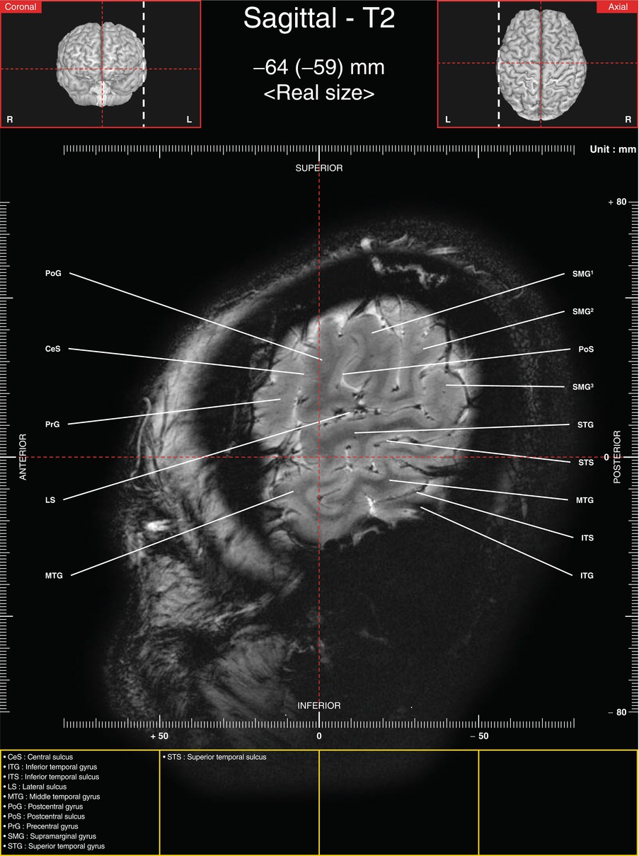 Sagittal Images of Tractography and Corresponding In-Vivo 7.0-T MRI ...