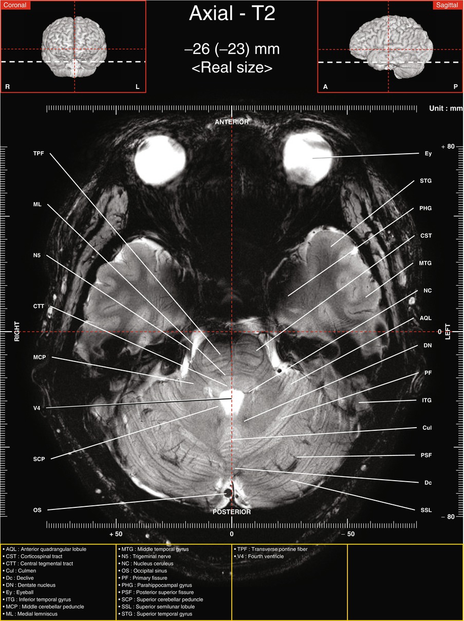 Axial Images of Tractography and Corresponding In-Vivo 7.0-T MRI ...