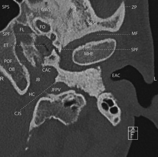 HRCT Axial Reformat | Radiology Key