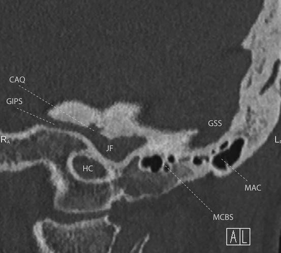 HRCT Stenvers Reformat | Radiology Key