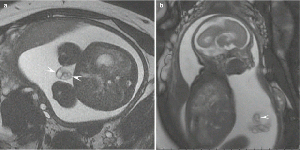 MR of the Fetus | Radiology Key