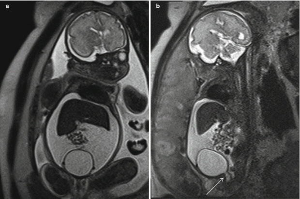 MR of the Fetus | Radiology Key