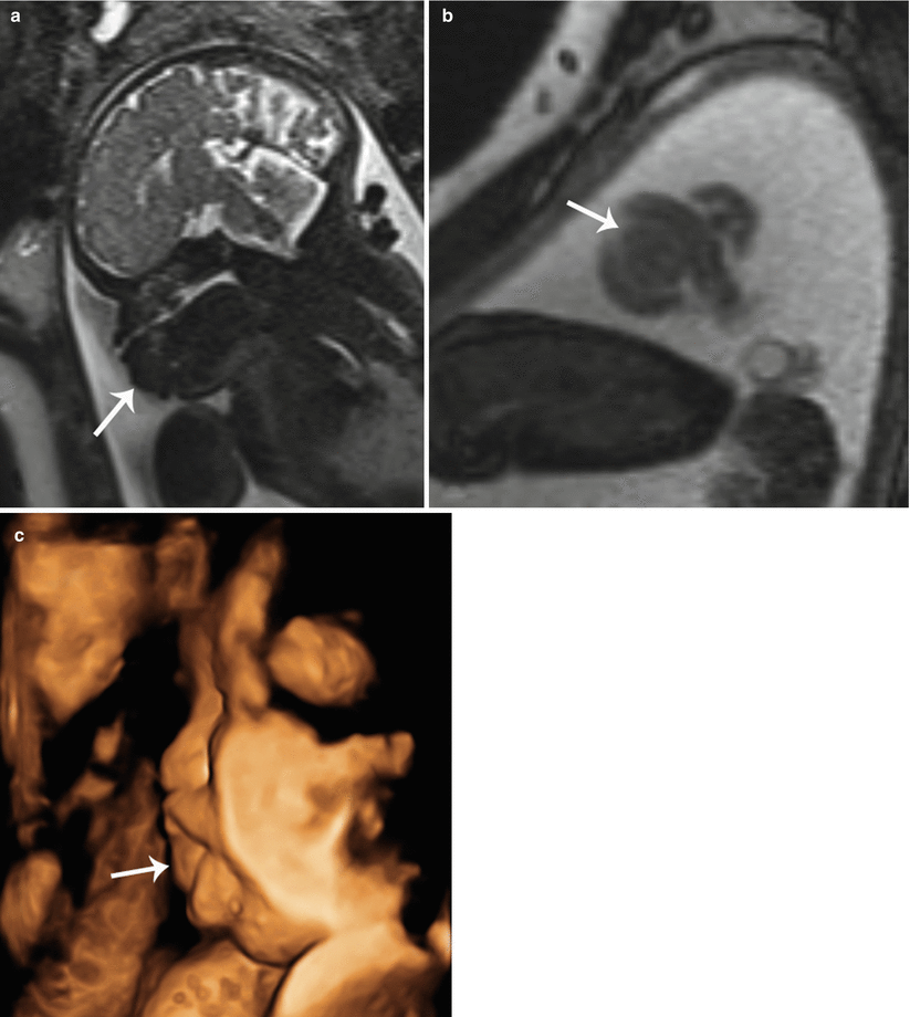 MRI of the Fetal Head and Neck | Radiology Key