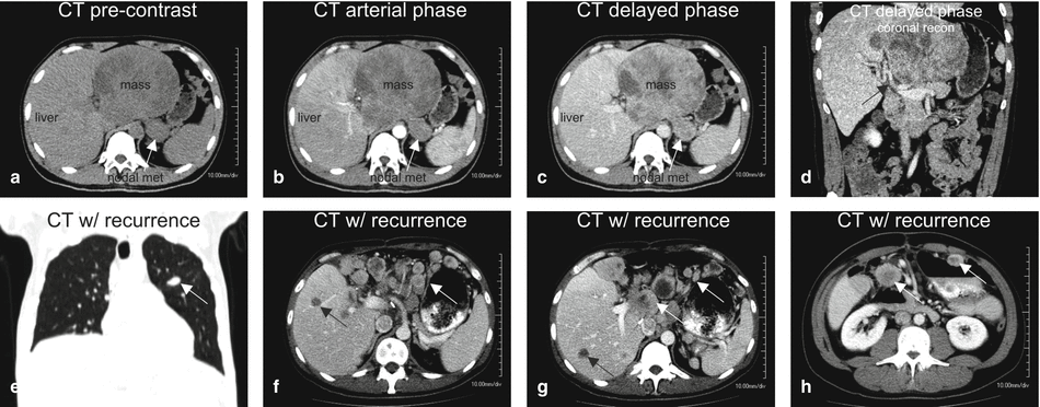 Liver Lesions | Radiology Key