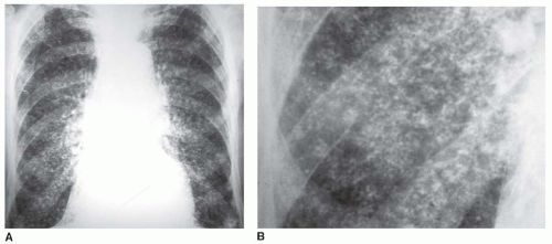 Pneumoconioses | Radiology Key