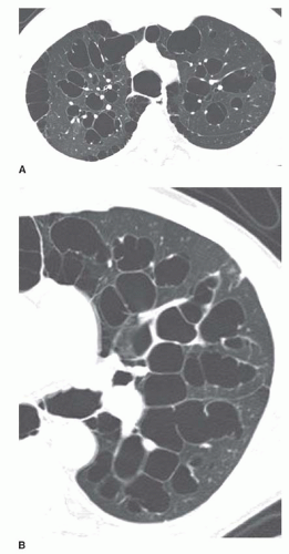 The Trachea | Radiology Key