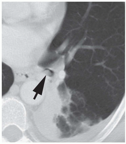 Lung Cancer and Bronchopulmonary Neoplasms | Radiology Key