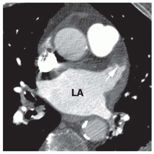 Cardiac and Paracardiac Masses | Radiology Key