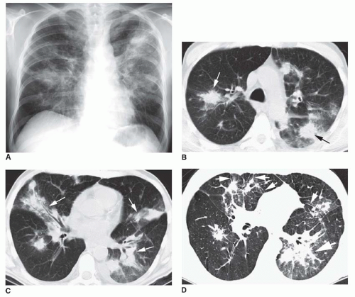 Metastatic Tumor | Radiology Key