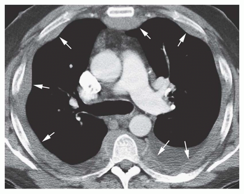 Lymphoma and Lymphoproliferative Disease | Radiology Key