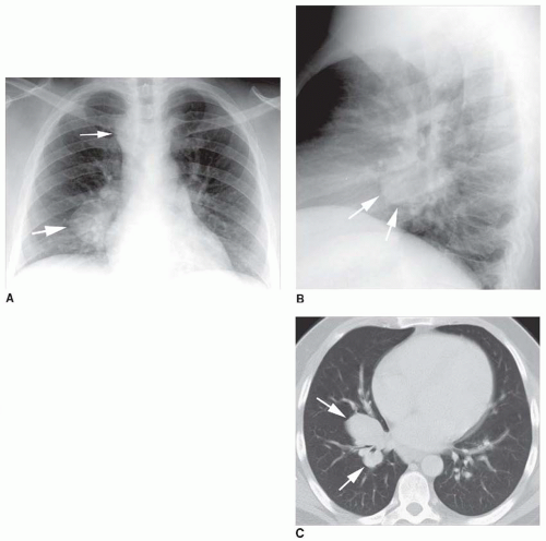 The Pulmonary Hila | Radiology Key