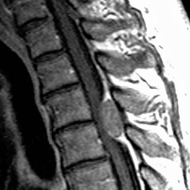 Bone Infarction | Radiology Key