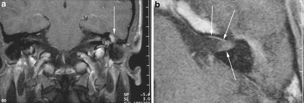 Otomastoiditis and its Complications | Radiology Key
