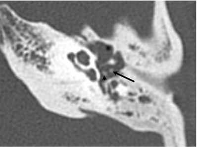Otomastoiditis without Cholesteatoma | Radiology Key