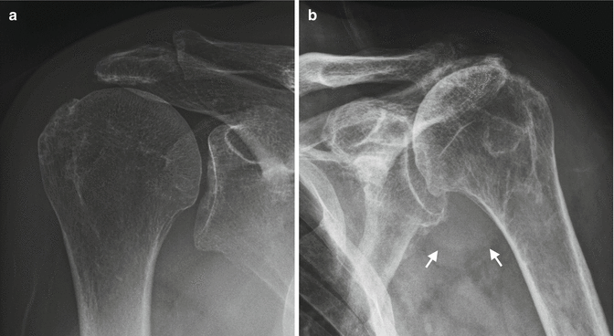 Osteoarthritis | Radiology Key