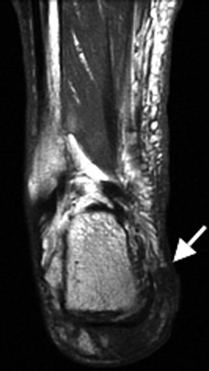The Diabetic Foot | Radiology Key