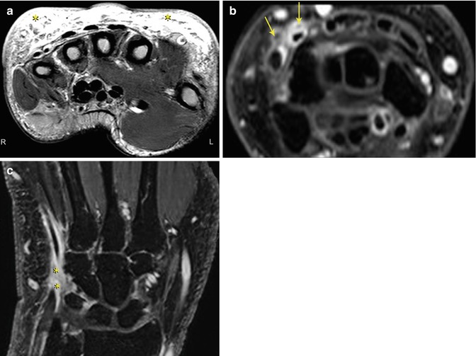 Inflammatory Arthritides | Radiology Key