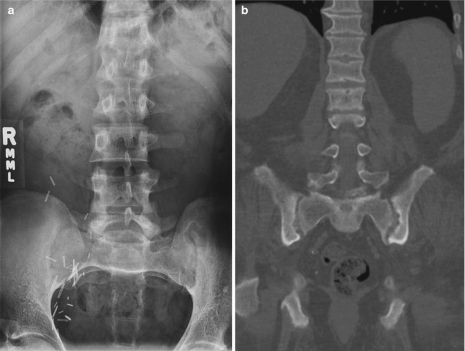 Spondyloarthropathy | Radiology Key