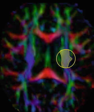 DTI Analysis Methods: Voxel-Based Analysis | Radiology Key