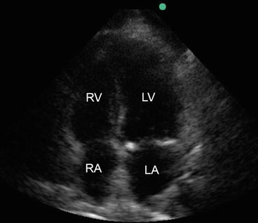 Intensive Care Unit Ultrasound for Venous Thromboembolism | Radiology Key