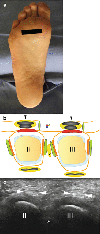 The Foot: Focused US Anatomy and Examination Technique | Radiology Key