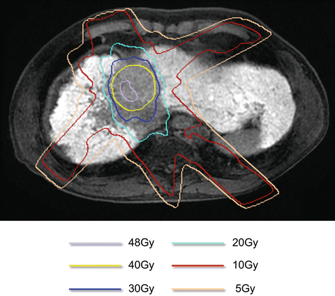 Liver Cancer (Hepatocellular Carcinoma; HCC) | Radiology Key