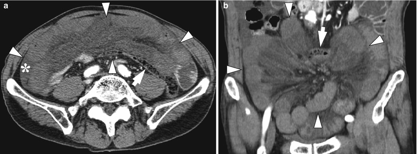 Small Bowel Obstruction | Radiology Key